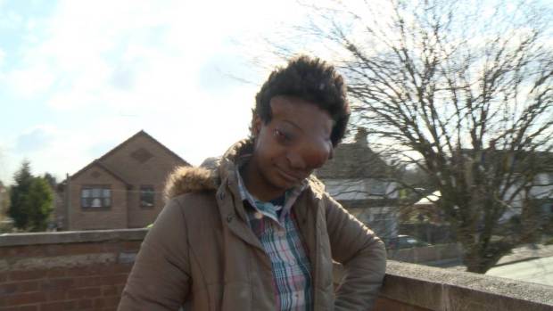 2kg짜리 종양을 머리에서 제거한 여성 | 위키트리